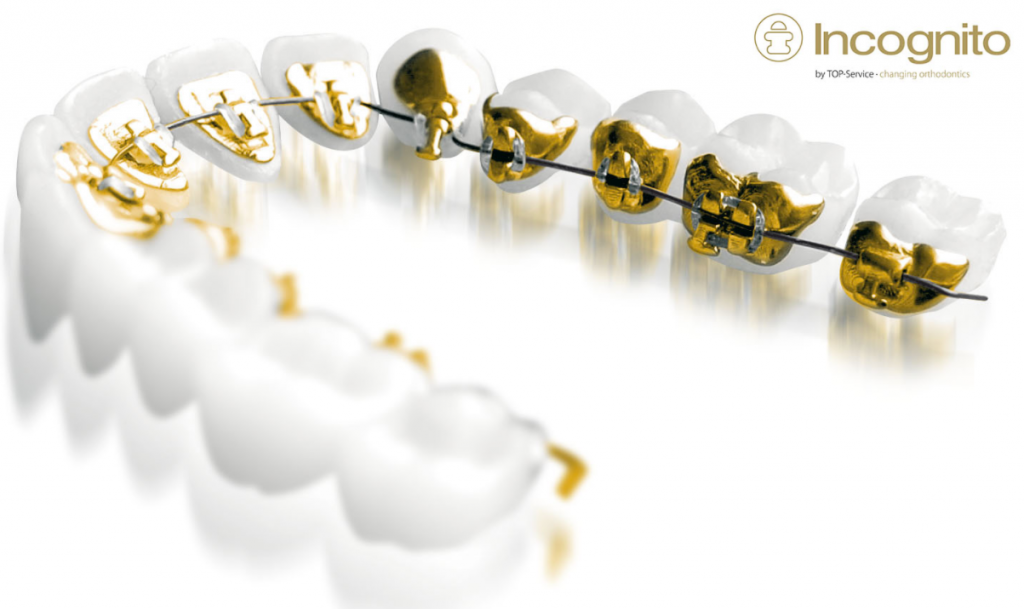 What Are Lingual Braces? Pros & Cons | Solas Orthodontics